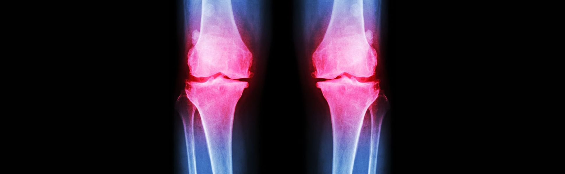 Osteoartritis | CaRabi